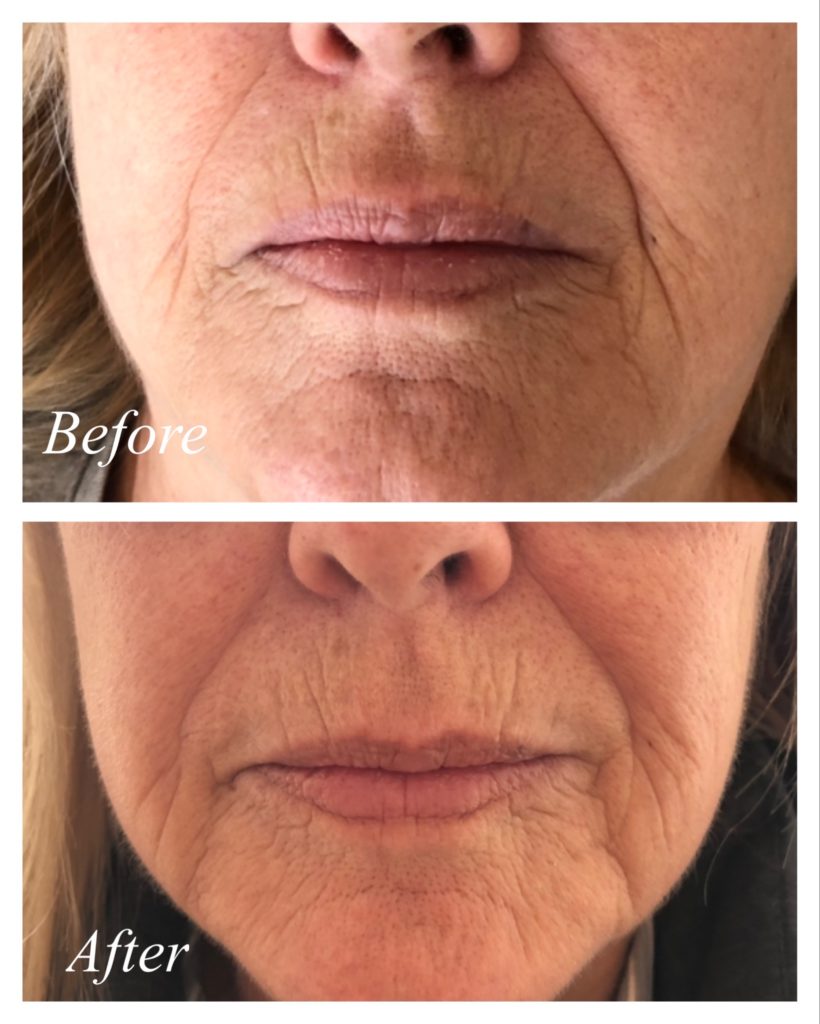 4 point lift - Angel Aesthetics